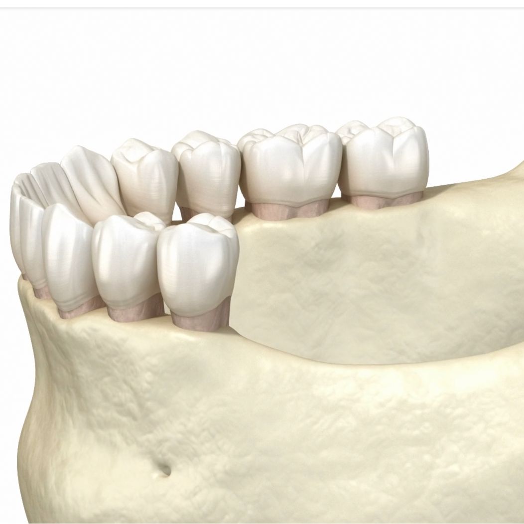 Ridge Augmentation - Monterey Oral Surgery & Dental Implants