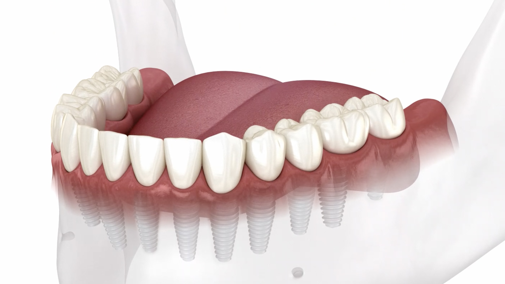 Replacing all Upper Teeth | Replacing all Lower Teeth