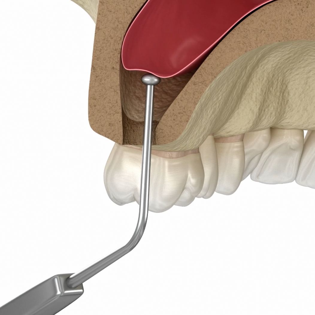 Sinus Lift - Upper Jaw Bone Graft
